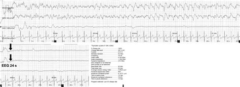 An Inadequate Response In The Ninth Session Bilateral Brief Pulse Ect