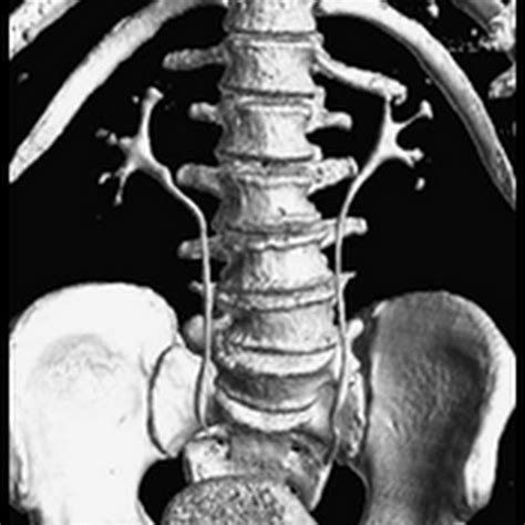 Shaded Surface Displays Of Ct Scan Abdominal Radiology Imaging