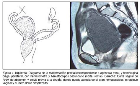 Diagrama De Agenesia Vaginal Características Clínicas Y Toma De