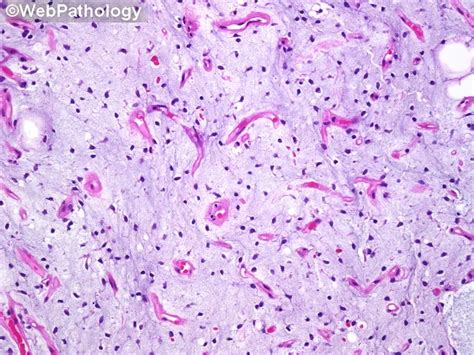 Myxoid Liposarcoma Microscopic