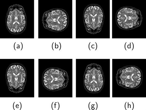 Data Augmentation A Original Mri Sample Bh Mri Samples After Download Scientific Diagram