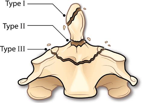 Diagram Of Odontoid Process Odontoid Fracture