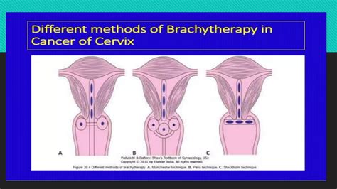 Radiotherapy 1pptx Radiotherapy 1pptx