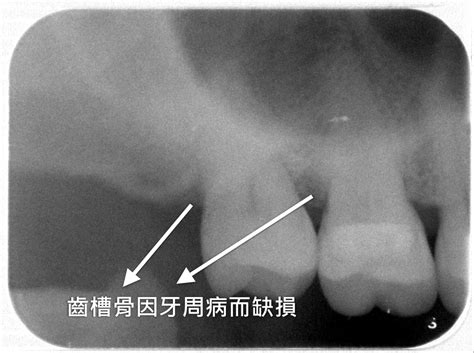 牙周病不可輕忽！北榮桃園分院：把握黃金治療時間靠這件事 蕃新聞