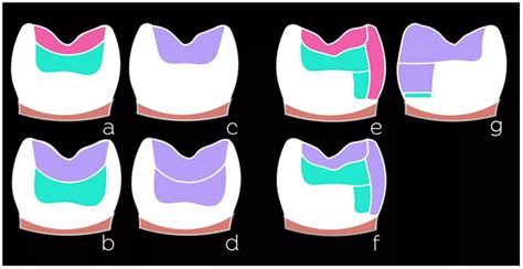 Bulk Fill Technique May Replace Incrementally Layered Conventional Resin Technique In Direct