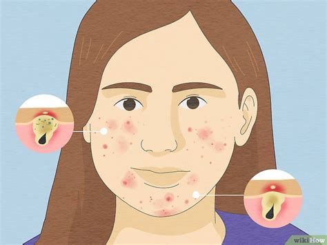 How To Tell If Your Acne Is Hormonal Or Bacterial