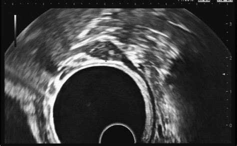 Ectopic Pancreas In The Antral Region Of The Stomach The Lesion Can Be Download Scientific