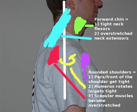 Neck Strain Massage Therapy Neck Strain Trigger Point Therapy