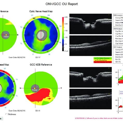 The Oct Tsnit And Gcc Of A 67 Year Old Hispanic Male With A Medical Download Scientific Diagram