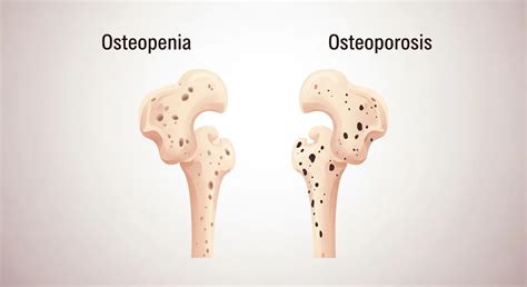 Osteoporosis Vs Osteopenia Key Bone Health Differences