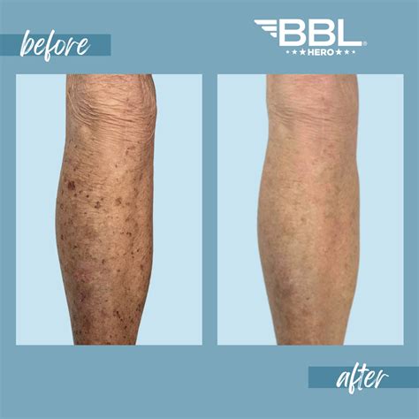 Sciton Bbl Treatment Denver Denver Bbl Laser Treatment