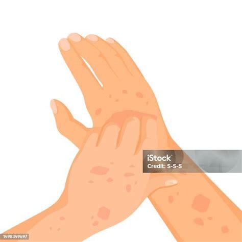 손에 발진 피부 발진 가려움증 손 붉은 반점 피부염 알레르기 증상 가려움증 두드러기 약 펠레 바이러스 습진 두드러기 자극 질병 벡터 일러스트레이션 햇볕에 탄에 대한 스톡