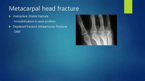 Metacarpal Fracture