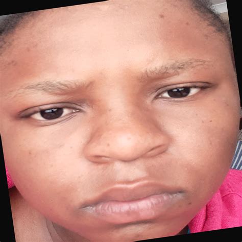 Acne Detection Object Detection Dataset And Pre Trained Model By