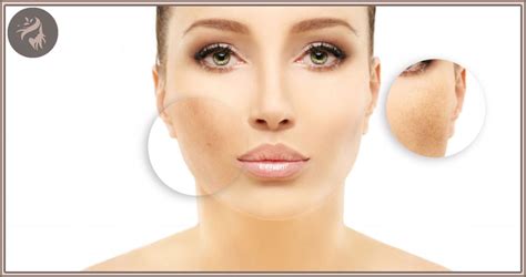 از بین بردن جای جوش با لیزر در اصفهان هزینه لیزر جای جوش در اصفهان دکتر مرجان حداد