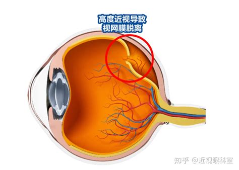 高度近视的危害，你知道多少？ 知乎