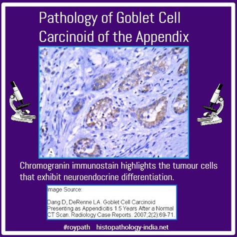 Educational  Pathology Of Goblet Cell Carcinoid Of The Appendix