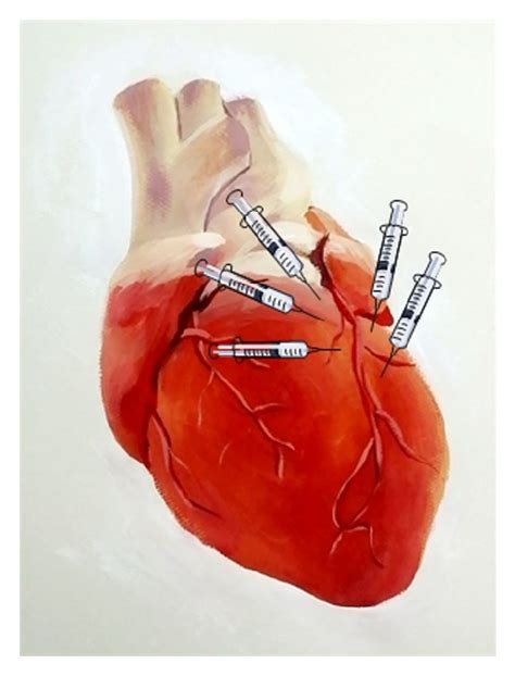 Intramyocardial Injection Into The Lv In Approximately Five Sites Download Scientific Diagram