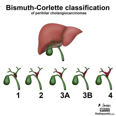 Bismuth Corlette Classification Radiology Human Digestive System Types Of Surgery