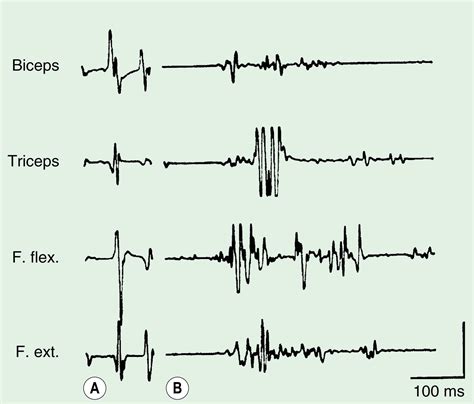 Myoclonus Phenomenology Etiology Physiology And Treatment