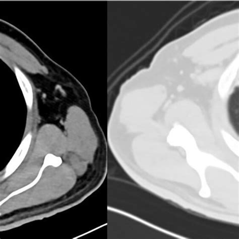A Endobronchial Ultrasound Showing Enlarged Precarinal Lymph Node