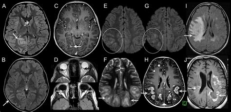Mog Igg Associated Disorders Mogad And Tumefactive Demyelination In