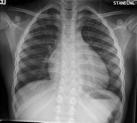Chest X Ray Challenge PEMBlog