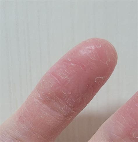 손가락 끝 피부 갈라짐 지식in