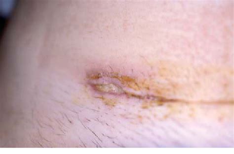 Figure 2 From Pyoderma Gangrenosum Following Cesarean Delivery Semantic Scholar