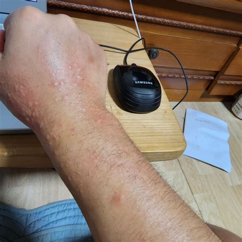 고무장갑을 끼면 두드러기가 생겨요 지식in