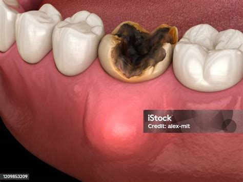 치주염과 잇몸 염증 의학적으로 정확한 치과 3d 일러스트레이션 이빨에 대한 스톡 사진 및 기타 이미지 이빨 낭포 종기 부상 Istock