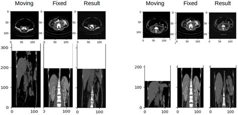 Two Examples Of 3d A F F Ine Registration Using Simpleelastix