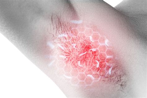 Reasons Causing An Underarm Rash And Ways To Ditch It