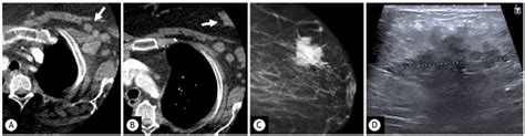 Axial Ct Images Show An Incidental Finding Of Multiple Left Axillary