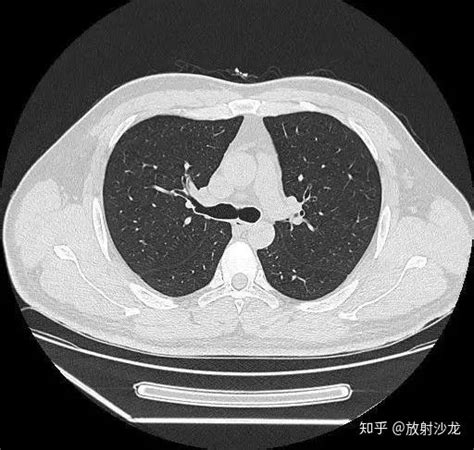 听说做一次CT所受到的辐射剂量和损害 拍400张X光片 知乎