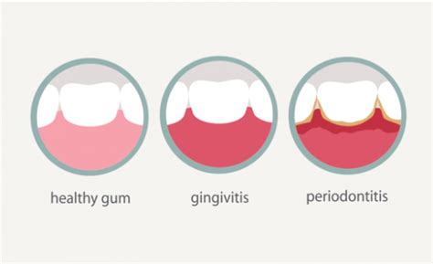 How To Treat Gum Disease And Gingivitis Risewell