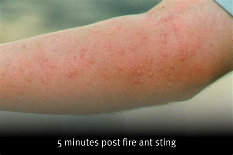Fire Ant Bite Fire Ant Stings National Fire Ant Eradication Program