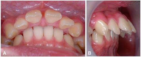 Class Ii Malocclusion With Severe Overjet Treated With Maxillary Second Molar Extractions And