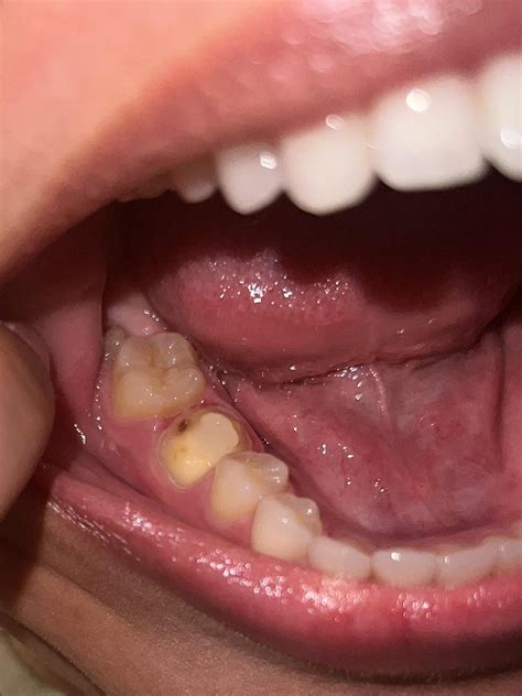 Crown Prep Sus R Askdentists