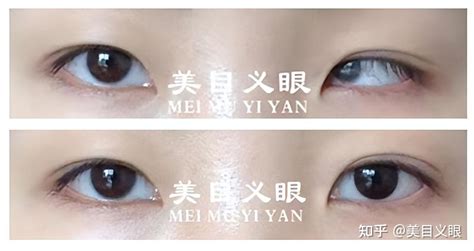 武汉美目义眼眼球萎缩是什么样的 知乎