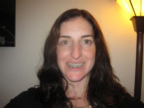 Jaw Surgery Jaw Wired Shut