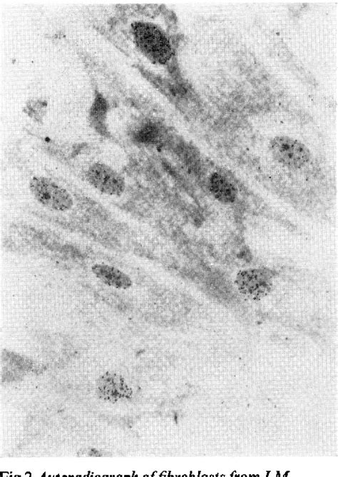 Figure 2 From Xeroderma Pigmentosum Semantic Scholar