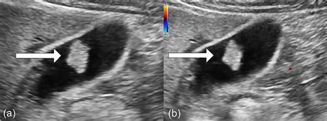 Risk Stratification Model For Incidentally Detected Gallbladder Polyps