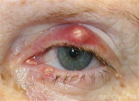 How Do You Treat A Chalazion And What Are Chalazions Patel Plastic