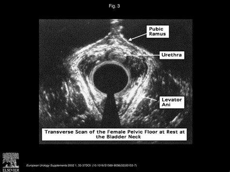 Incontinence And ProlapseAn Integrated View Ppt Download