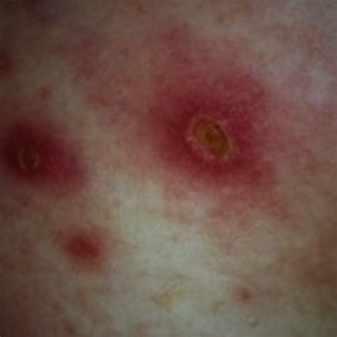 Streptococcus Bacterial Infection