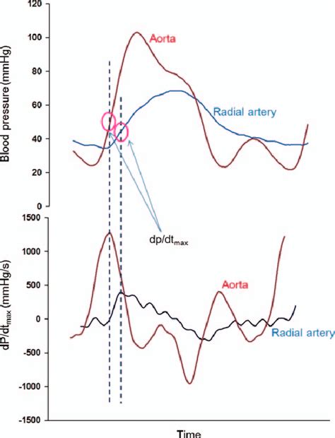 example tracings of arterial pressure waveforms upper panel and the