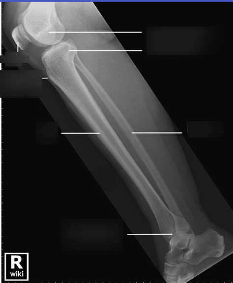 Tib Fib Anatomy Diagram Quizlet