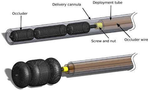 Occluder Deployment System The Occluder Attached To A Wire Via A Download Scientific Diagram