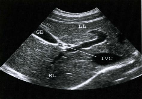 Ultrasound Image Of The Main Lobar Fissure Rumak Et Al2005 Gb Gall
